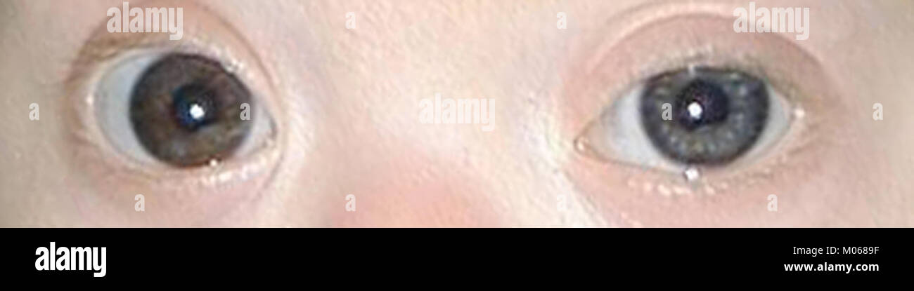 The image highlights a Brushfield eye, an eye anomaly commonly found in ...