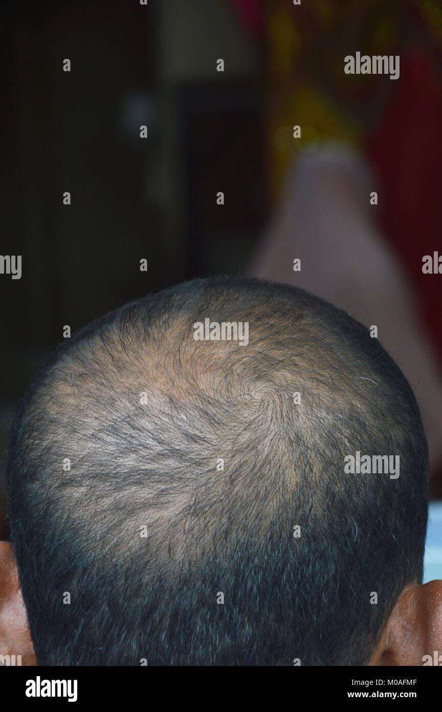 bald hair on the head Stock Photo - Alamy