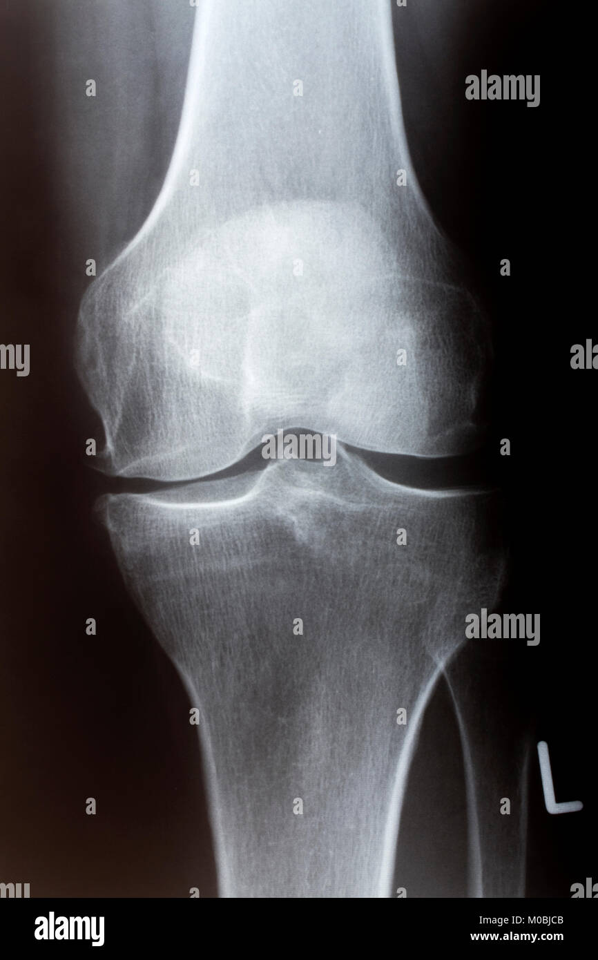 Human knee in front in x-ray Stock Photo - Alamy