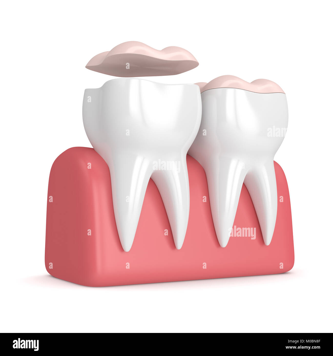 3d render of teeth with dental onlay over white background Stock Photo ...