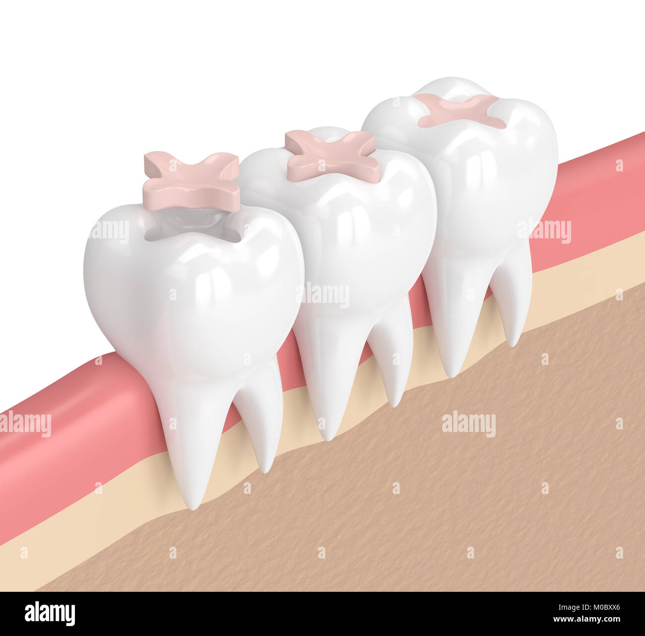 3d render of teeth with dental inlay filling in gums Stock Photo - Alamy