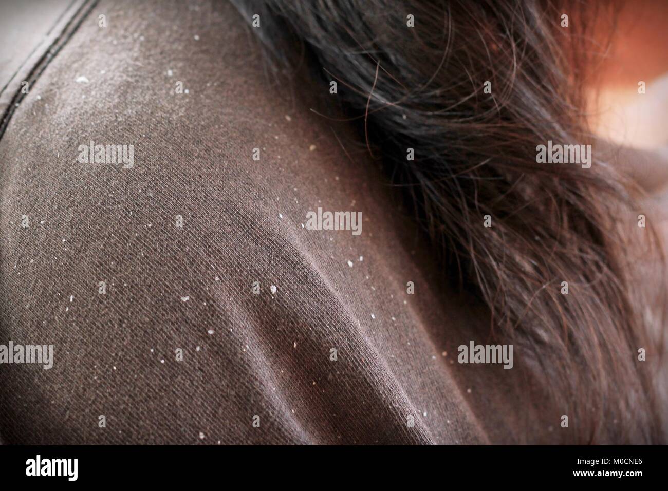 Dandruff Flakes Under Microscope