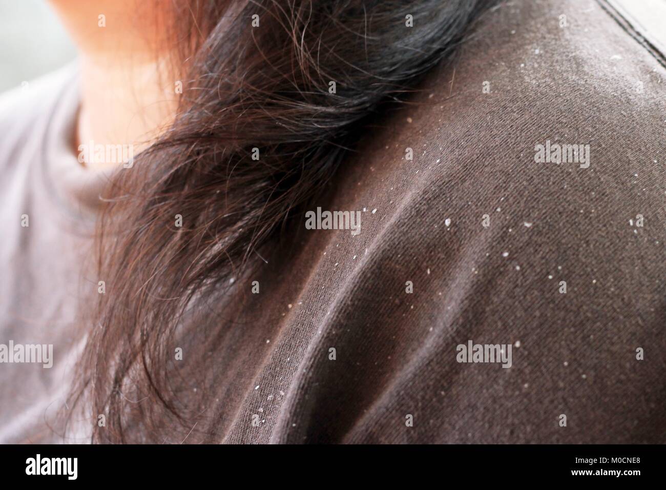 women having dandruff in the hair and shoulder Stock Photo - Alamy
