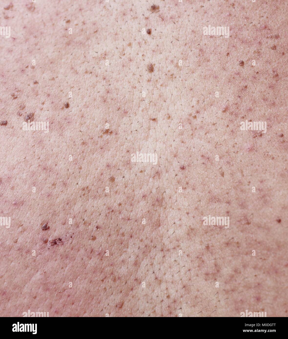 Girl with problematic skin and acne scars in the back Stock Photo - Alamy
