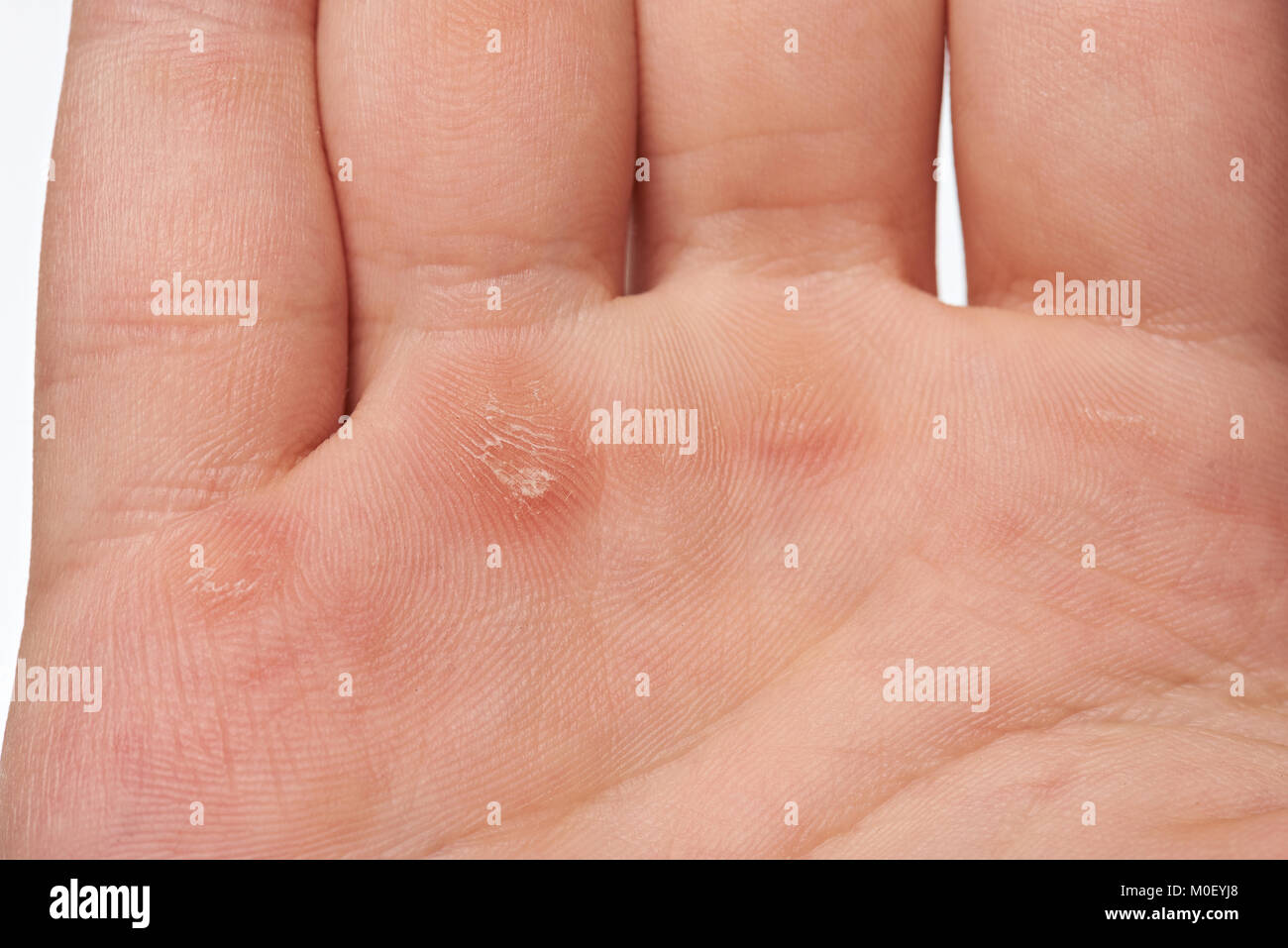 Blister on palm hi-res stock photography and images - Alamy