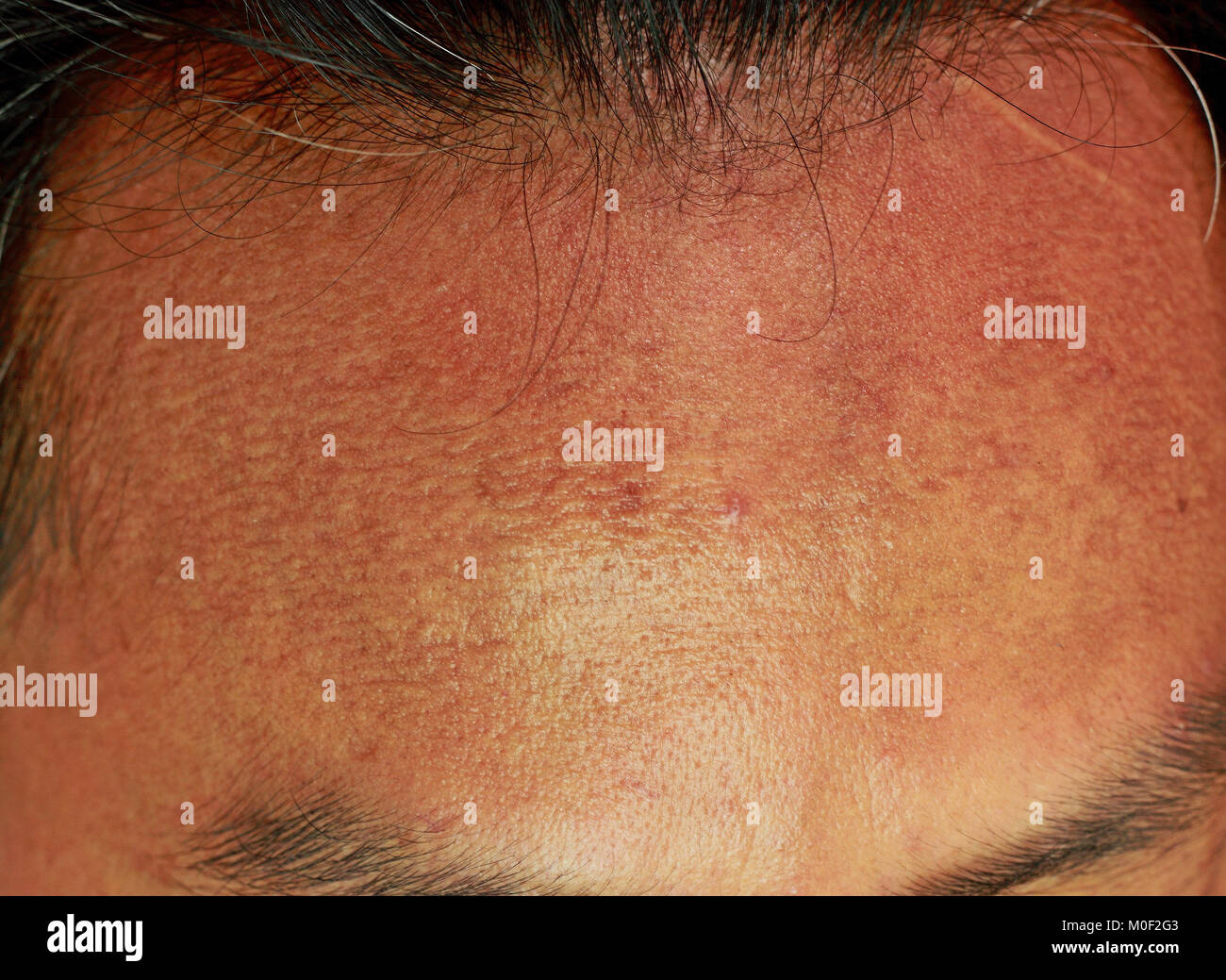 Spot forehead hi-res stock photography and images - Alamy
