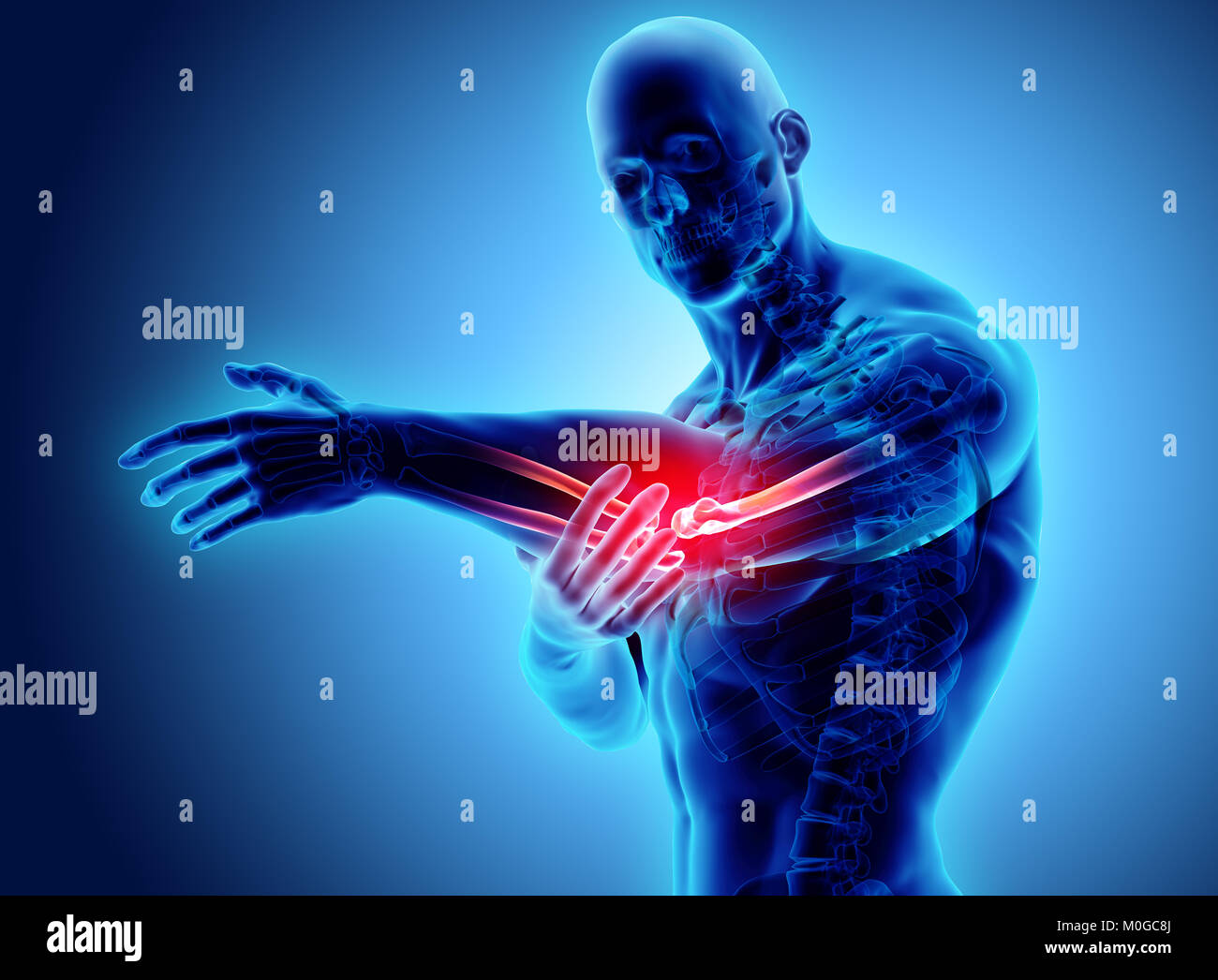 3d illustration of human elbow injury, medical concept Stock Photo - Alamy