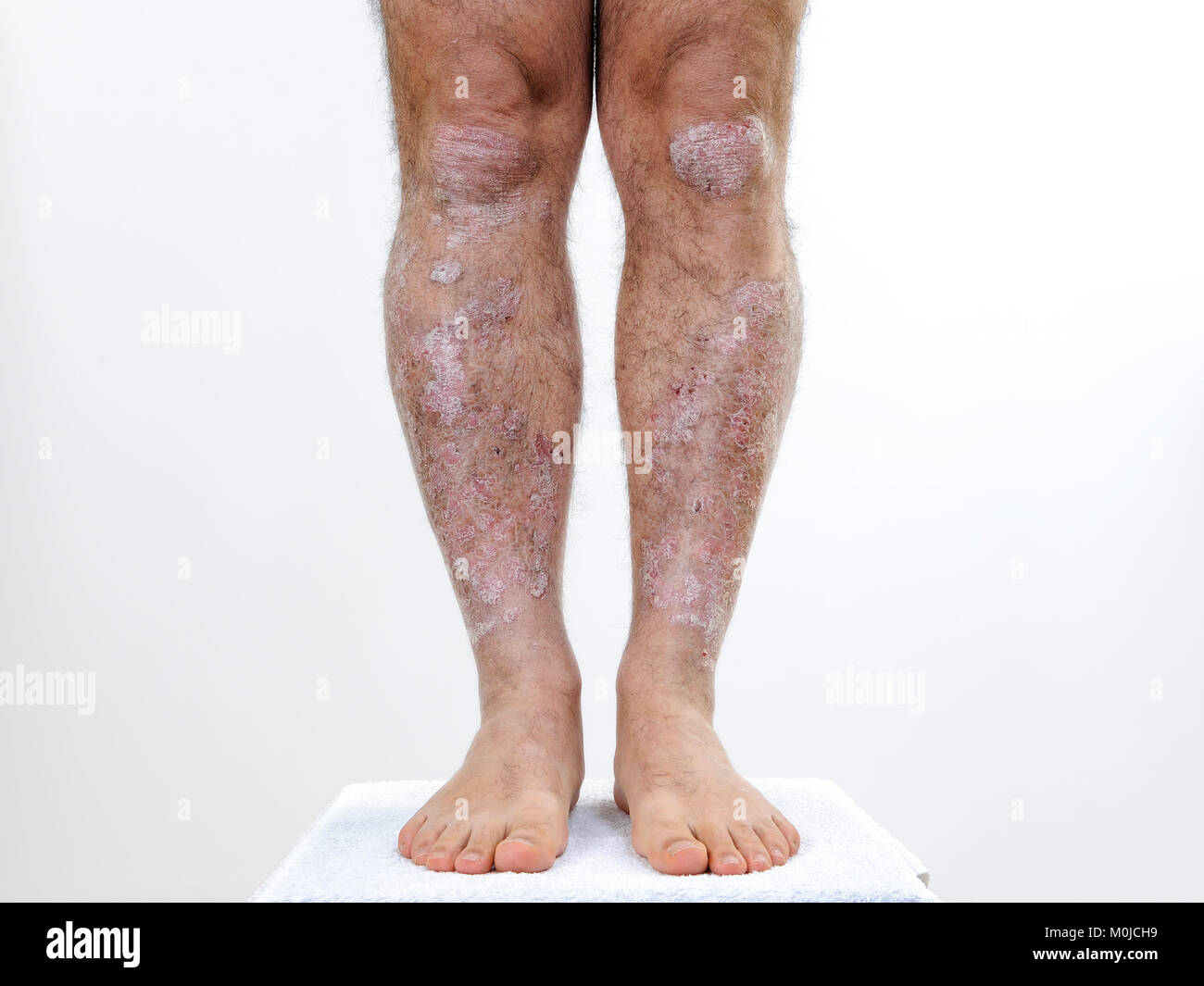 Close up of the front of the legs of a person suffering from chronic ...