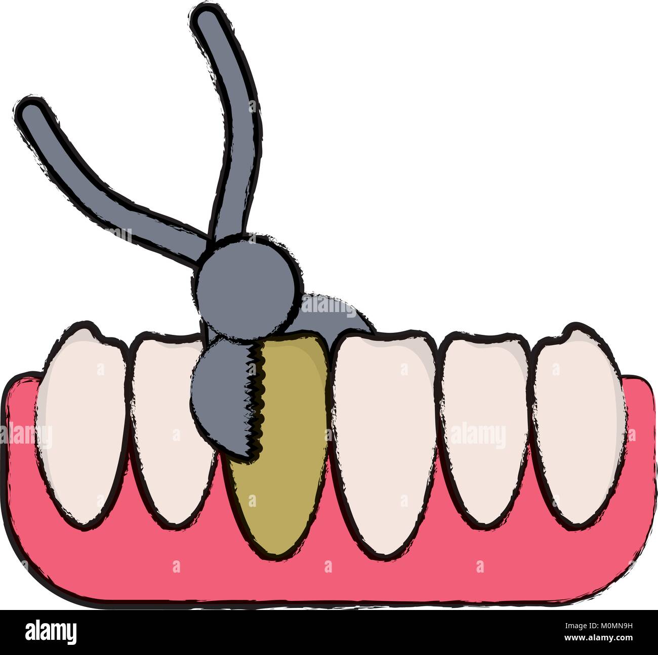 Tooth Extraction High Resolution Stock Photography and Images - Alamy