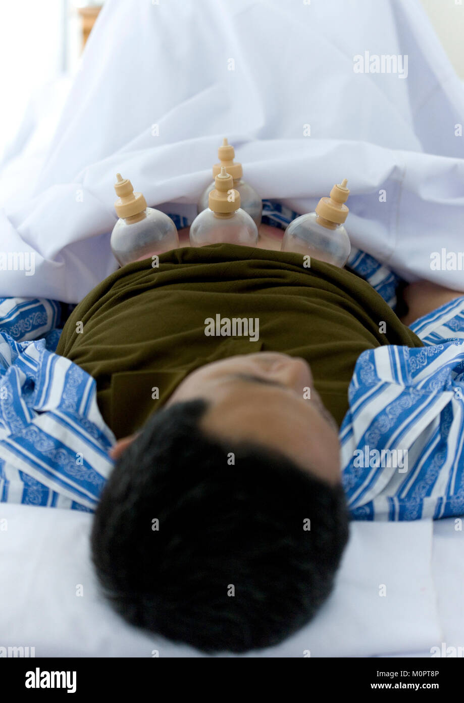 North Korean man having traditional cupping medicine in hopsital ...