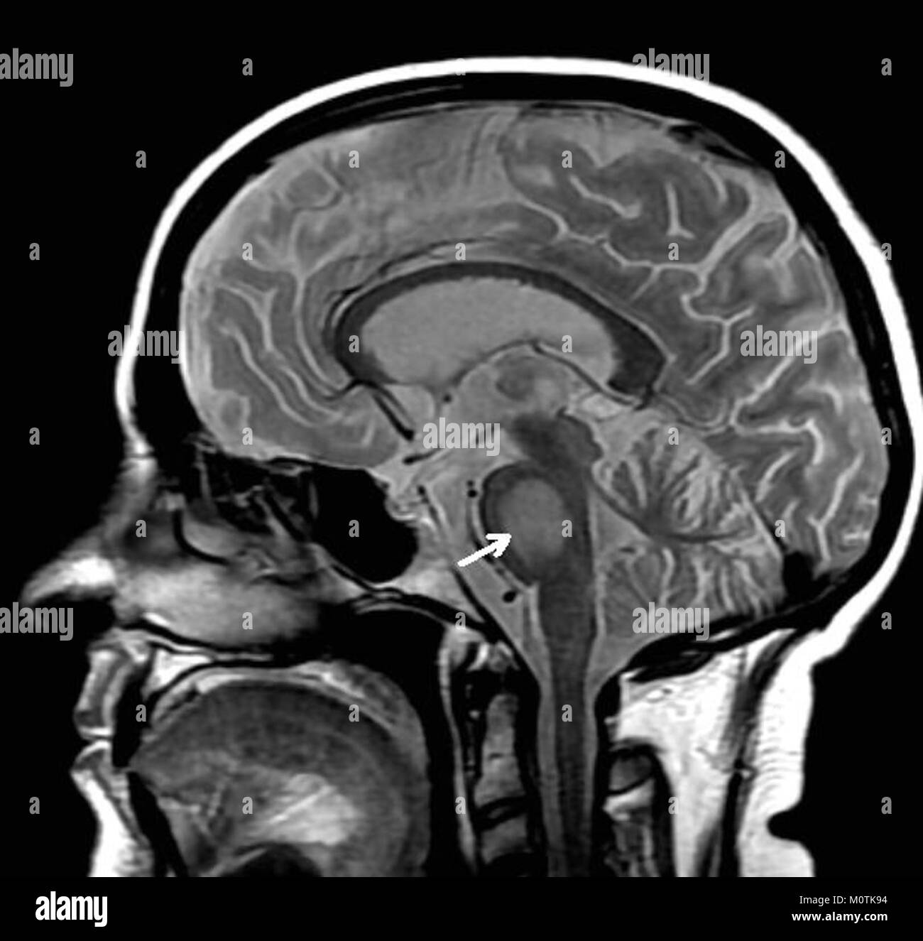 Central pontine myelinolysis hi-res stock photography and images - Alamy