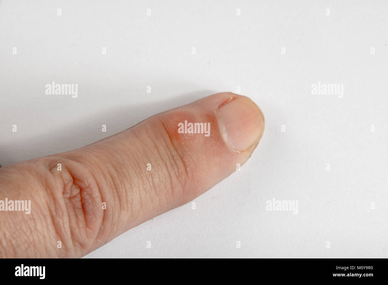 Ganglion cyst hi-res stock photography and images - Alamy