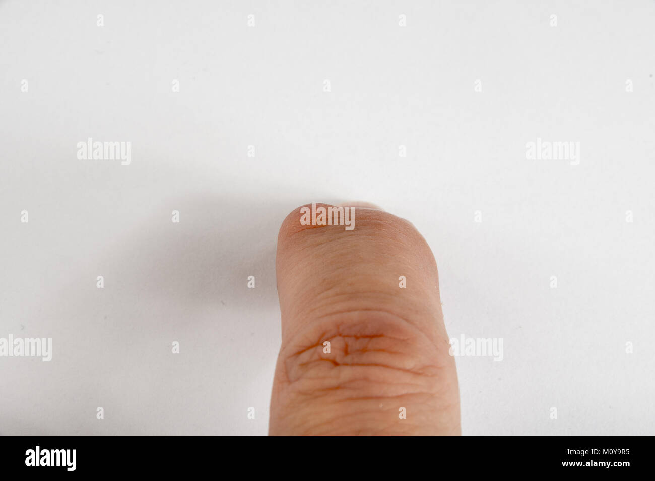 Ganglion cyst hi-res stock photography and images - Alamy