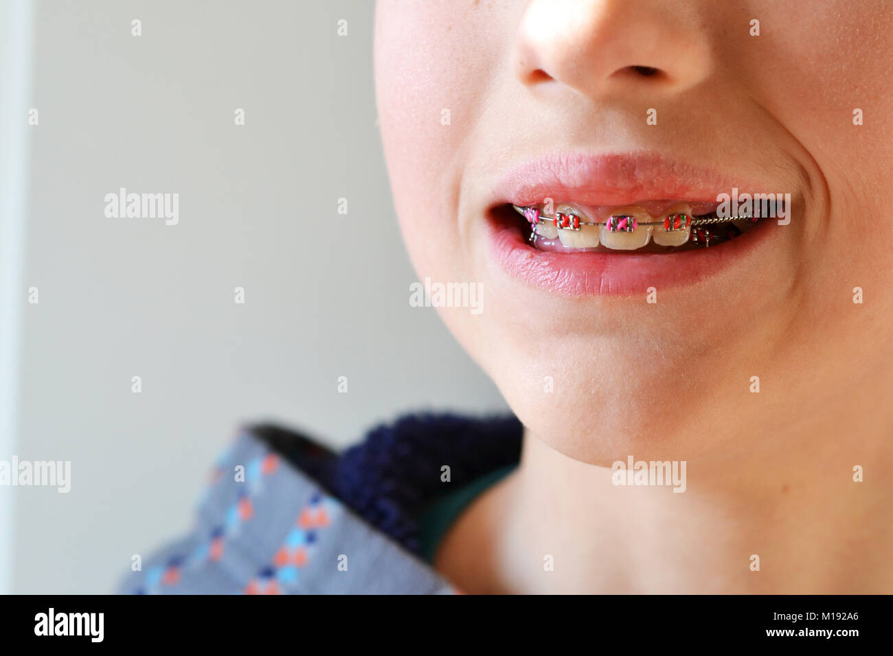 Boy with orthodontics braces hi-res stock photography and images - Alamy