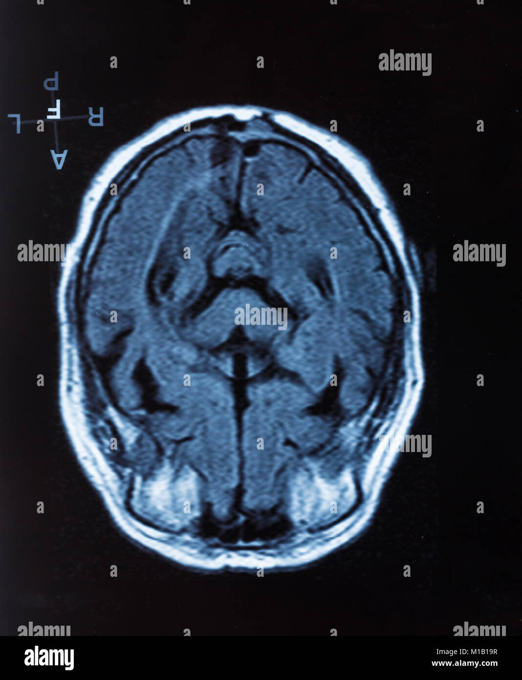 Head MRT. MR image of human brain Stock Photo - Alamy