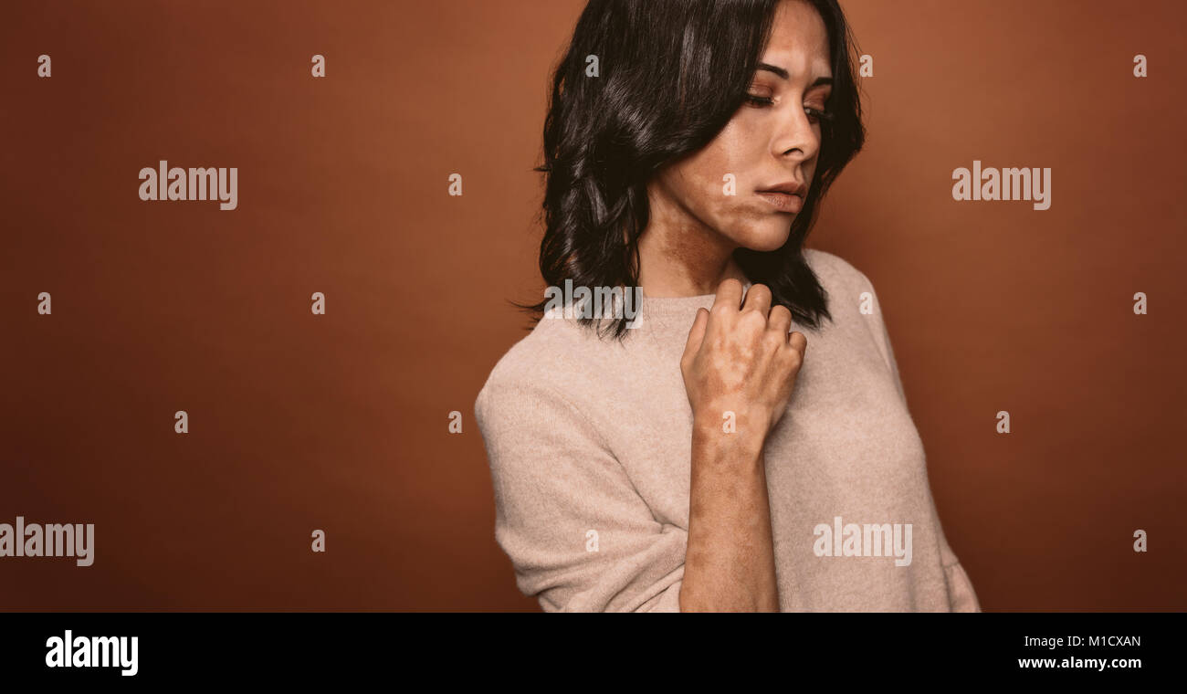 Skin affected by vitiligo hi-res stock photography and images - Alamy
