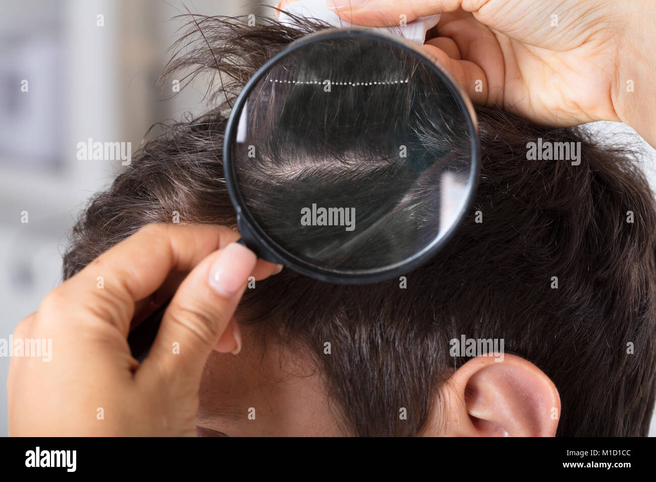 Close-up Of A Dermatologist's Hand Checking Patient's Hair With ...