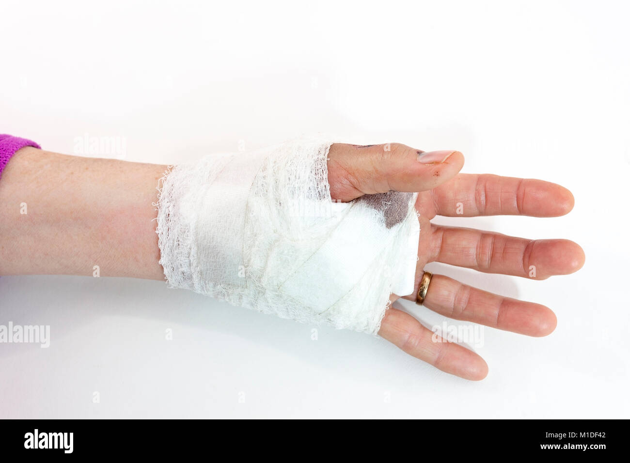 Bandaged female hand Stock Photo - Alamy