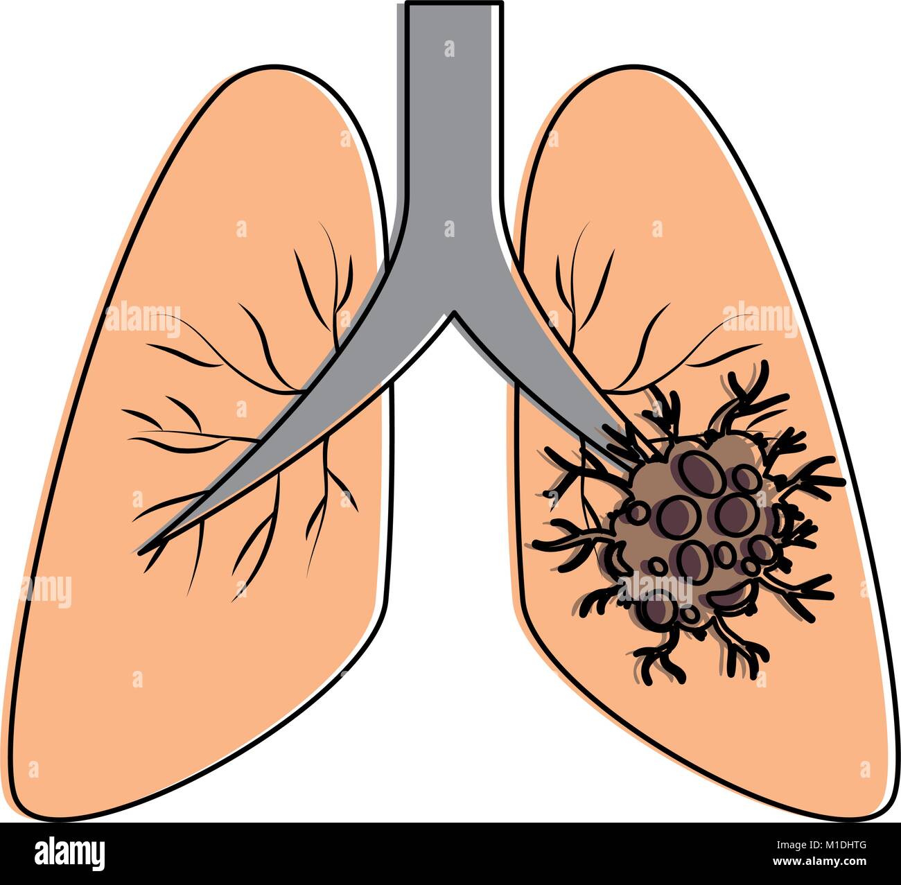 Lung Cancer Stock Vector Images - Alamy