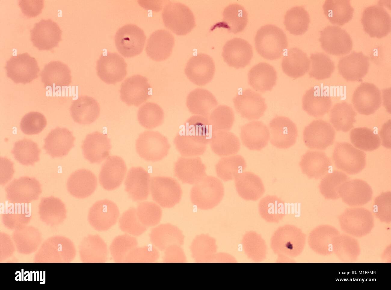 Micrograph image including both growing Plasodium falciparum ...