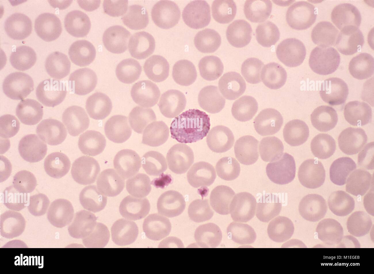 Plasmodium vivax microgametocyte revealed in blood smear ...