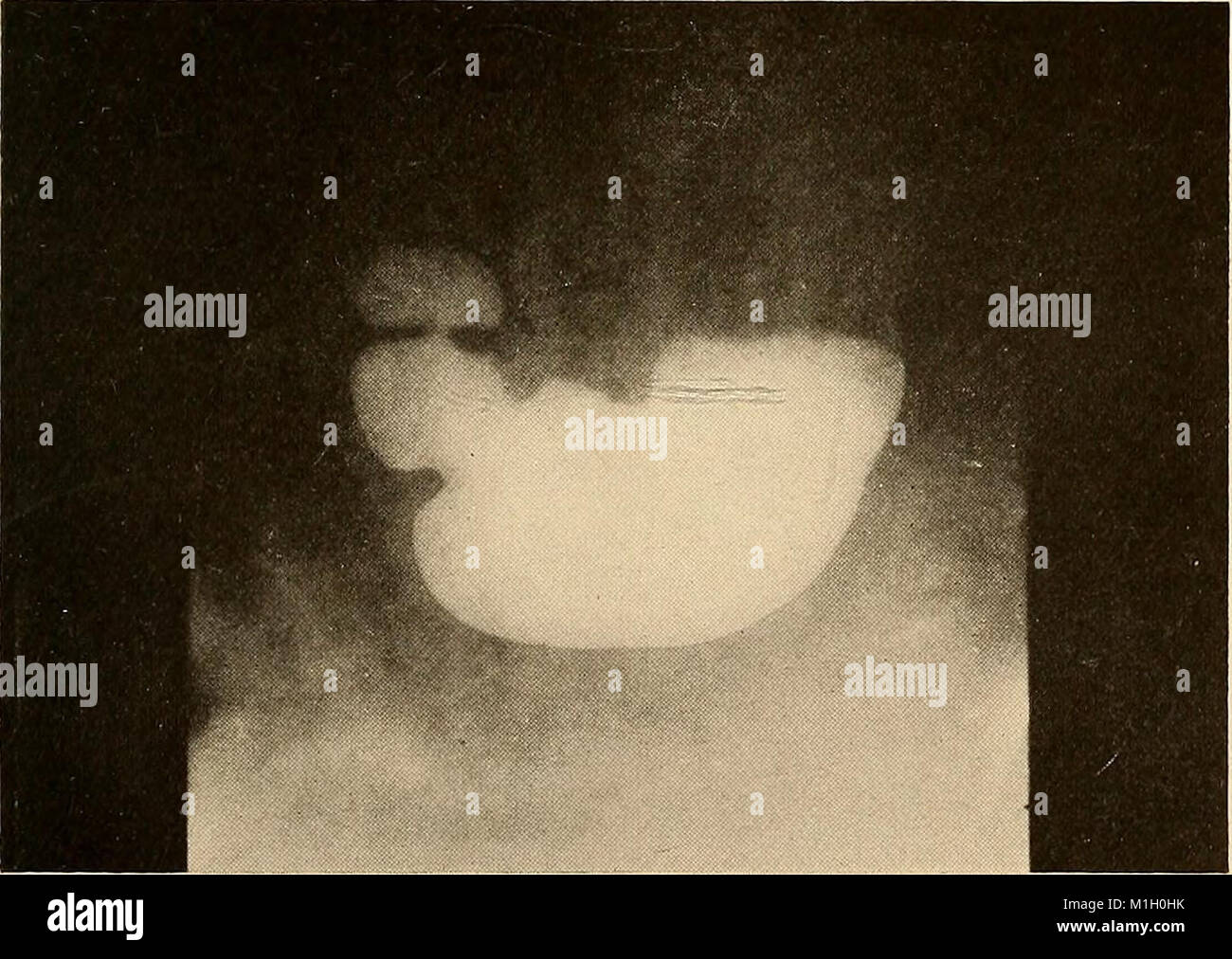 The 1917 manual provides a detailed explanation of X-ray techniques ...