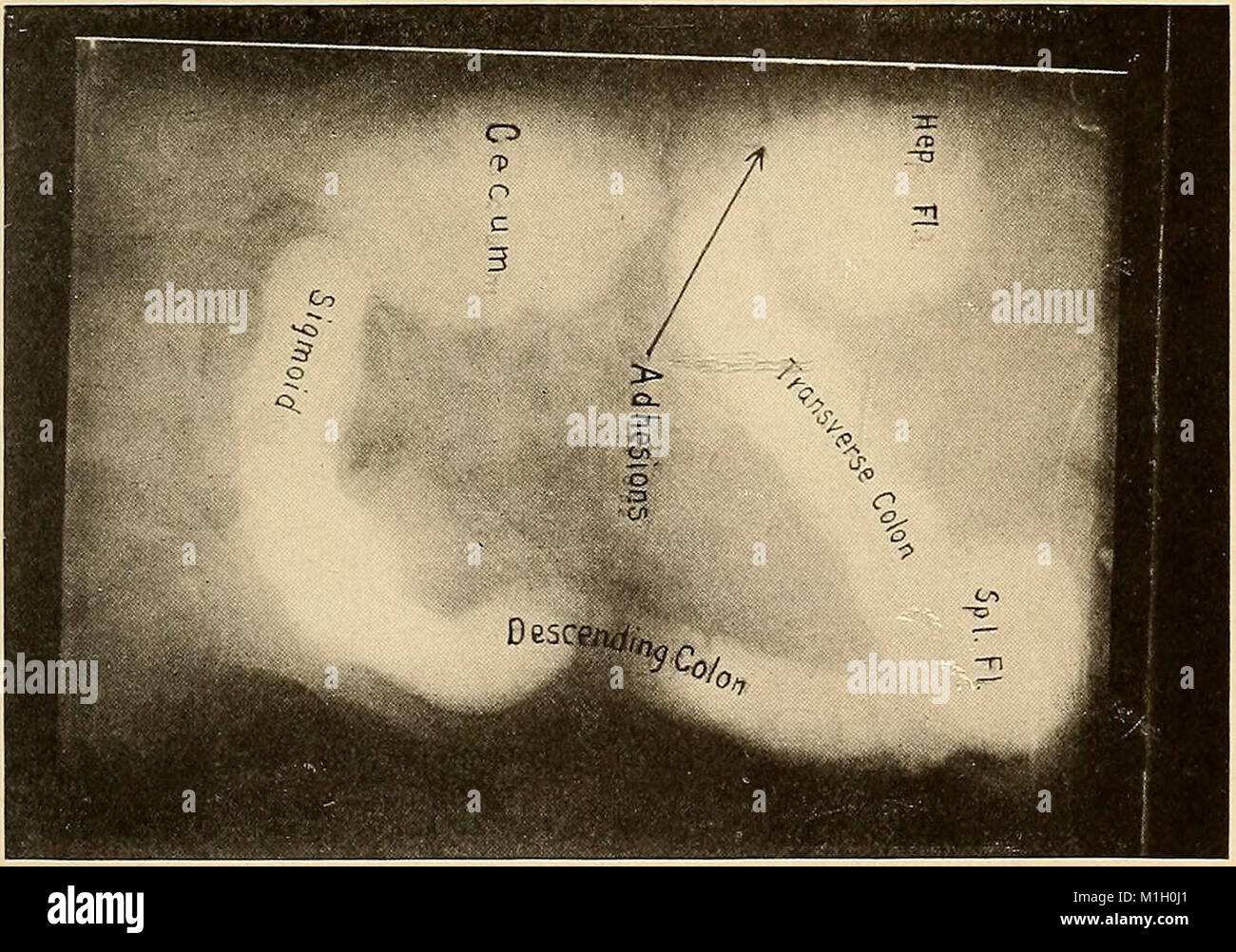Manual x ray hi-res stock photography and images - Alamy
