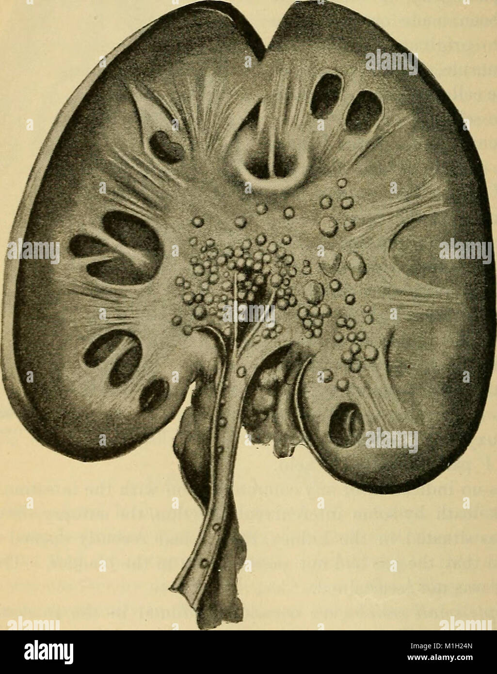 A system of genito-urinary diseases, syphilology and dermatology (1893 ...