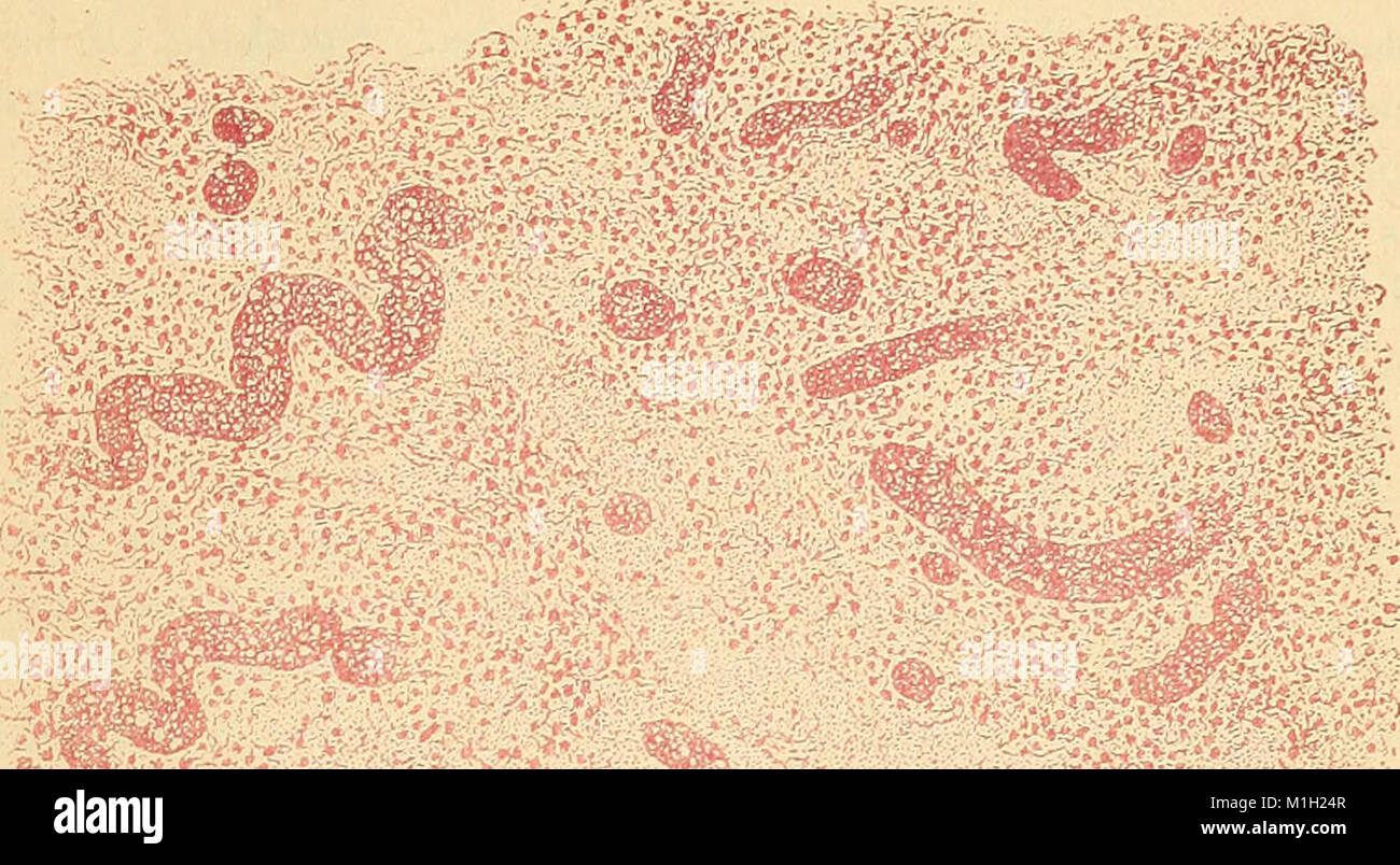 A system of genito-urinary diseases, syphilology and dermatology (1893 ...