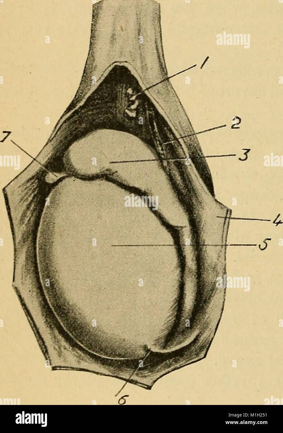A system of genito-urinary diseases, syphilology and dermatology (1893 ...
