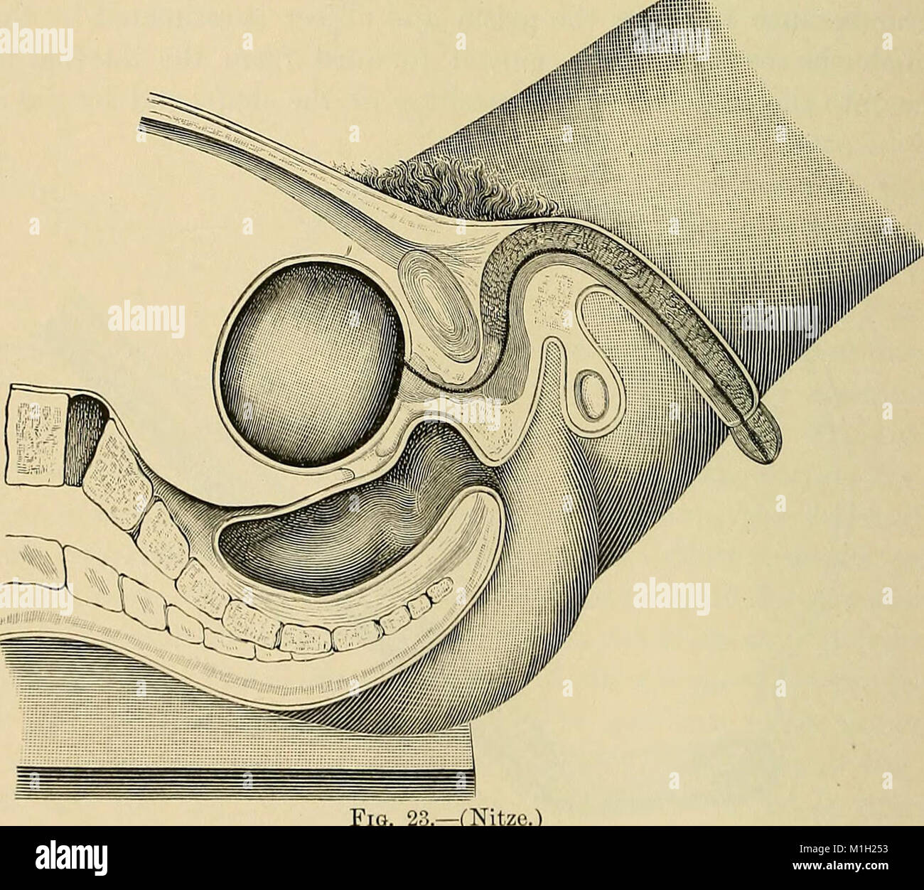 This 1893 medical work outlines the diagnosis and treatment of genito ...