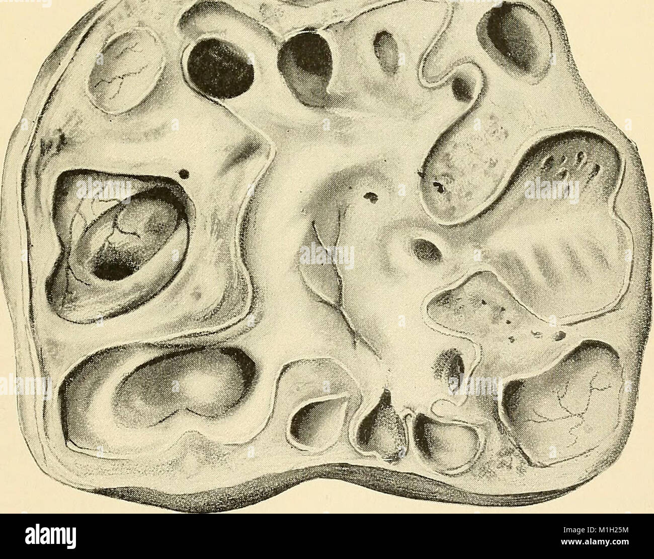 A system of genito-urinary diseases, syphilology and dermatology (1893 ...