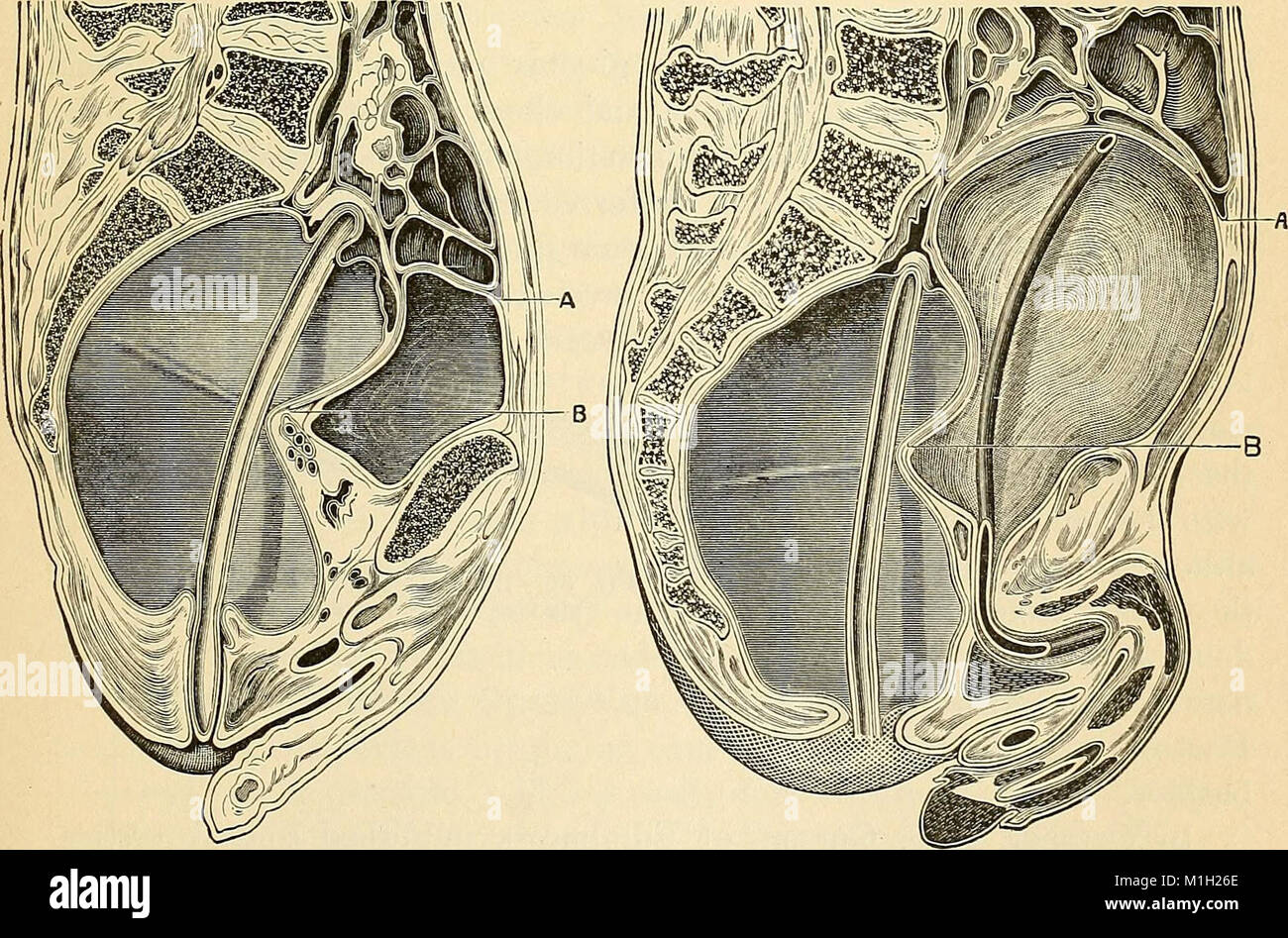 A system of genito-urinary diseases, syphilology and dermatology (1893 ...