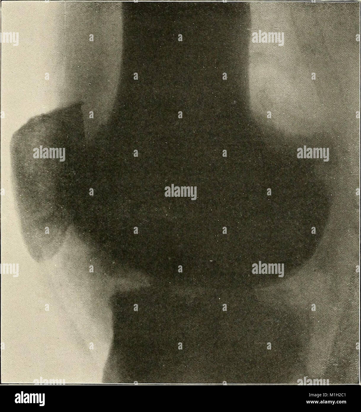 This 1911 atlas presents detailed radiographic images of pathologic ...