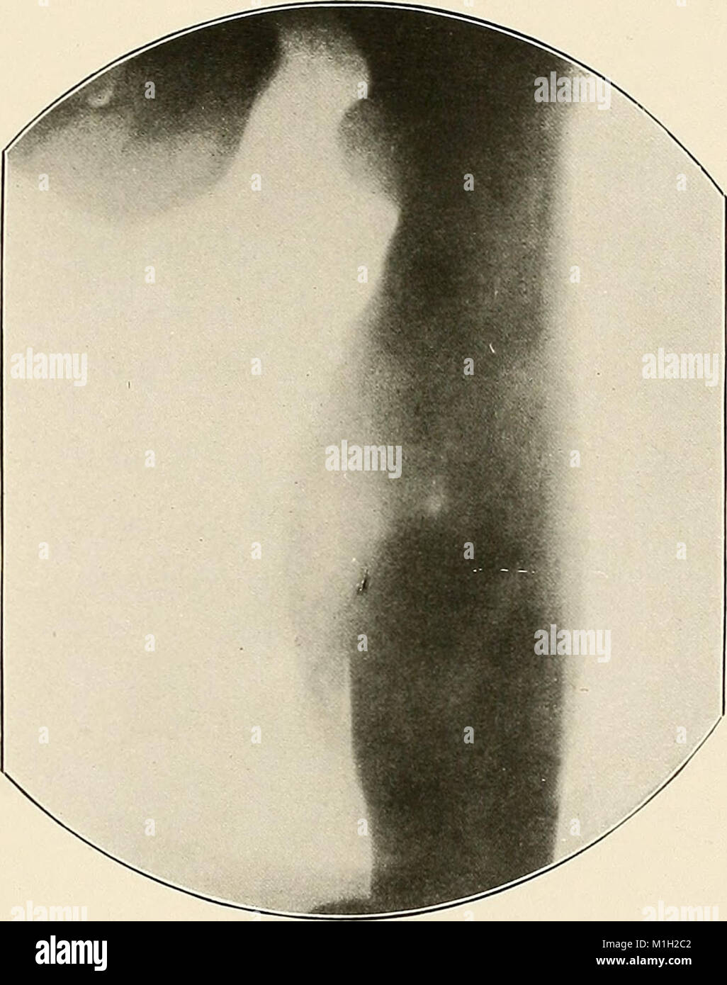 This 1911 radiographic atlas details the pathologic changes observed in ...