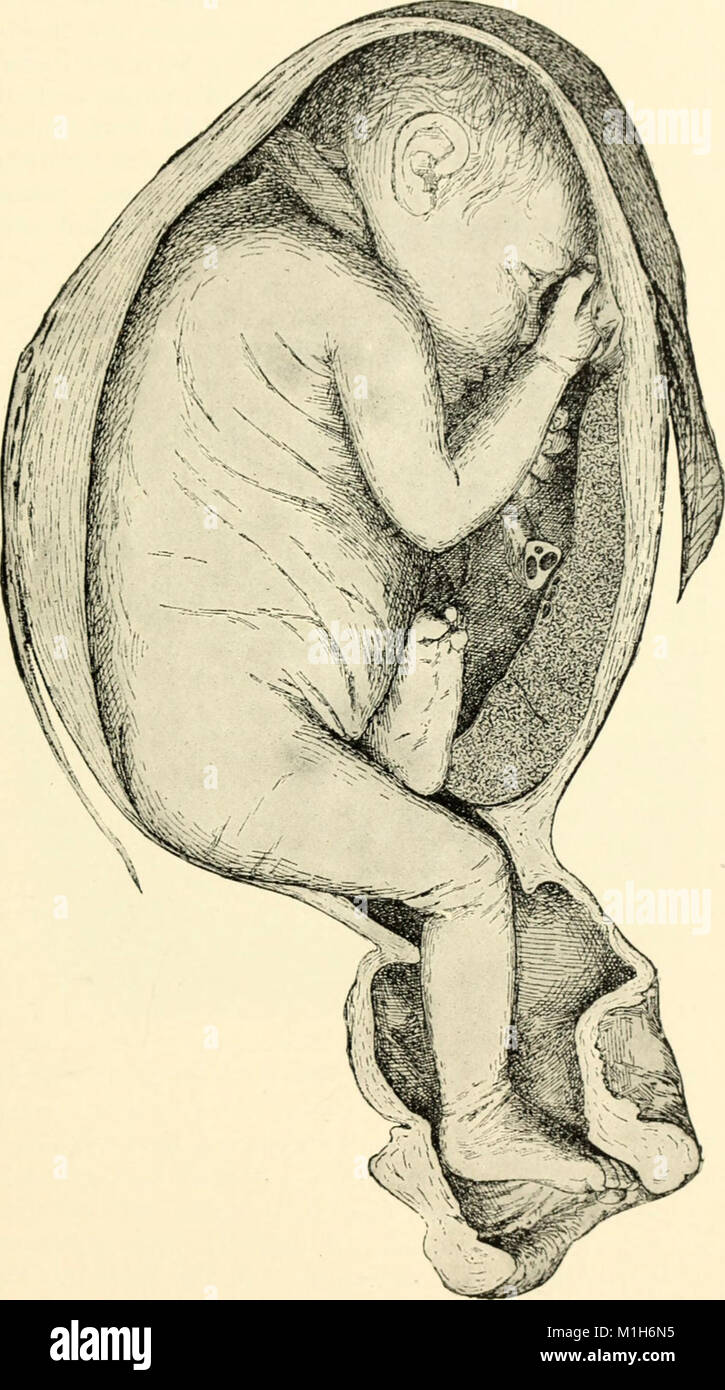 This 1899 textbook of obstetrics provides comprehensive information on ...