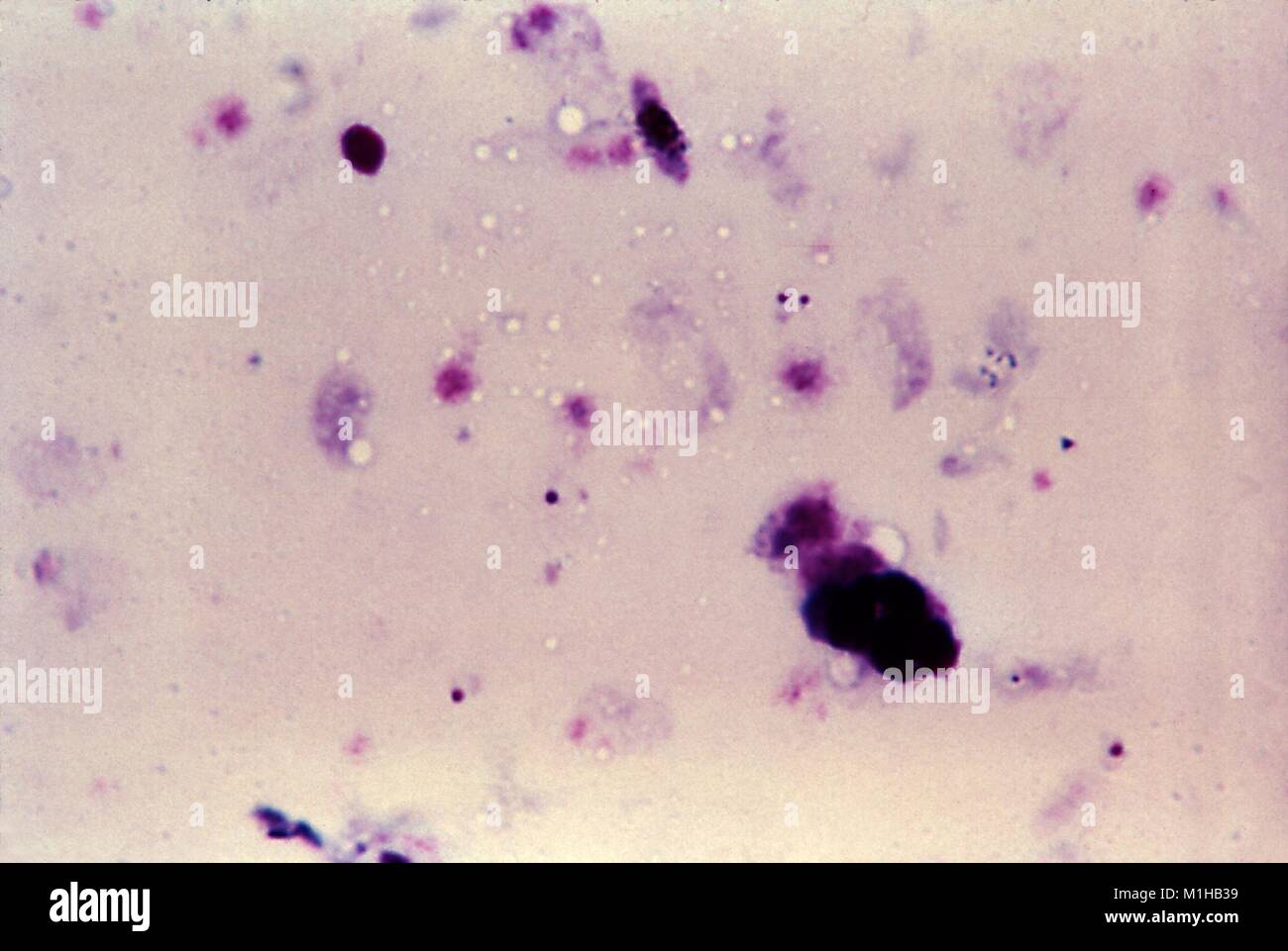 Plasmodium Falciparum Thick Smear