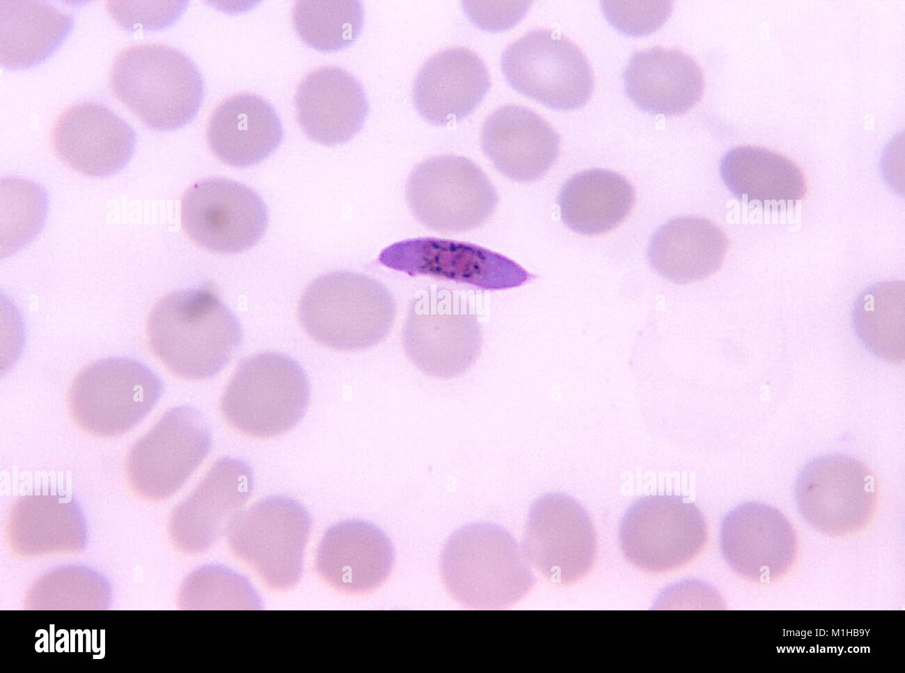 Plasmodium Falciparum Thick Smear