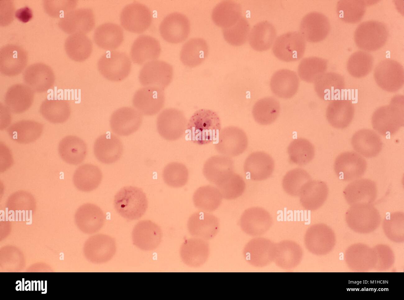 Infected RBCs with Plasmodium vivax, revealed on a thin micrograph film ...