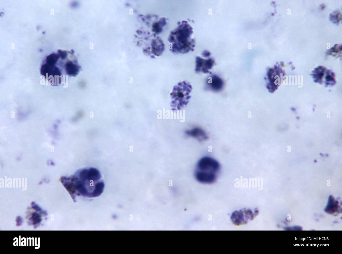 Plasmodium vivax revealed in thick micrograph film using Giemsa stain ...