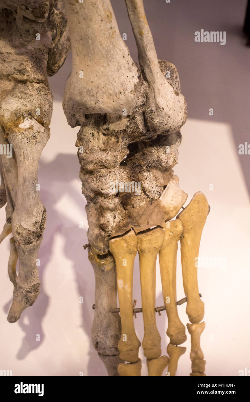 The left foot of Peter Cluckeys skeleton, who died of chronic ...