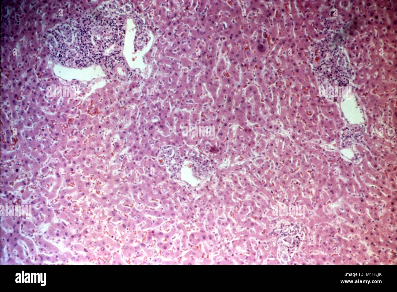 Photomicrograph of a liver section with triaditis (liver triads ...