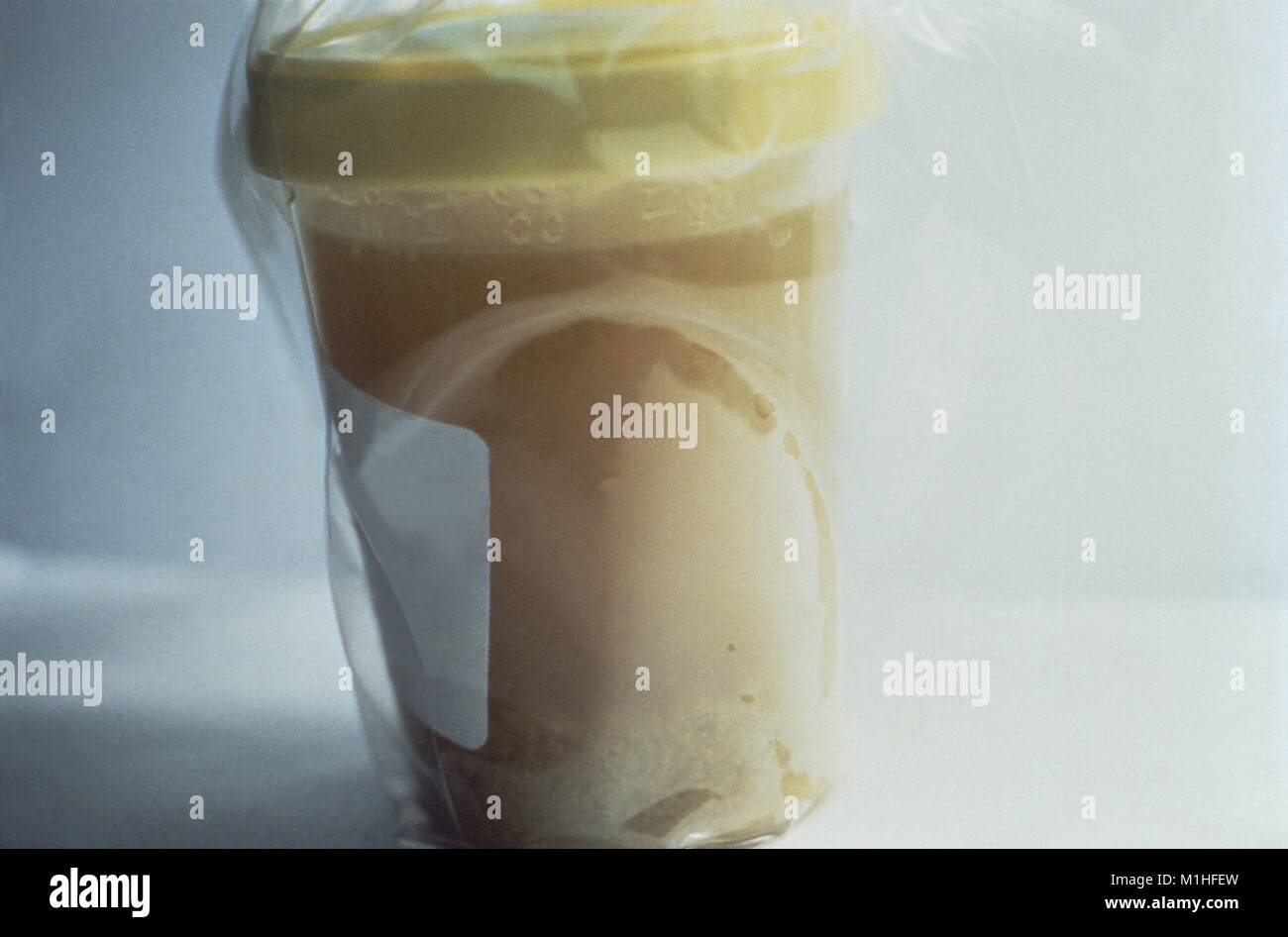 Patient of cholera hi-res stock photography and images - Alamy