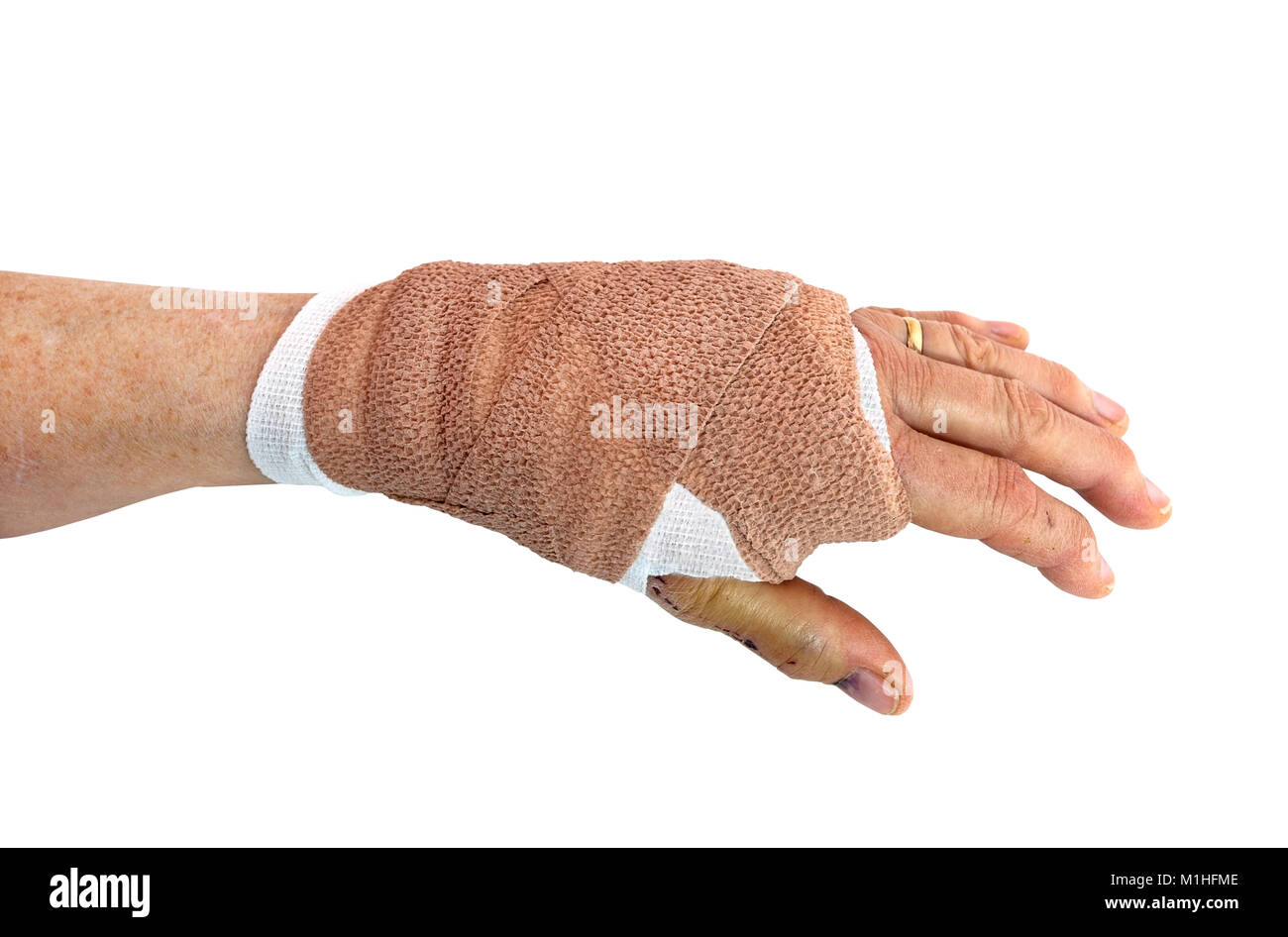 Smashed Hand Injury