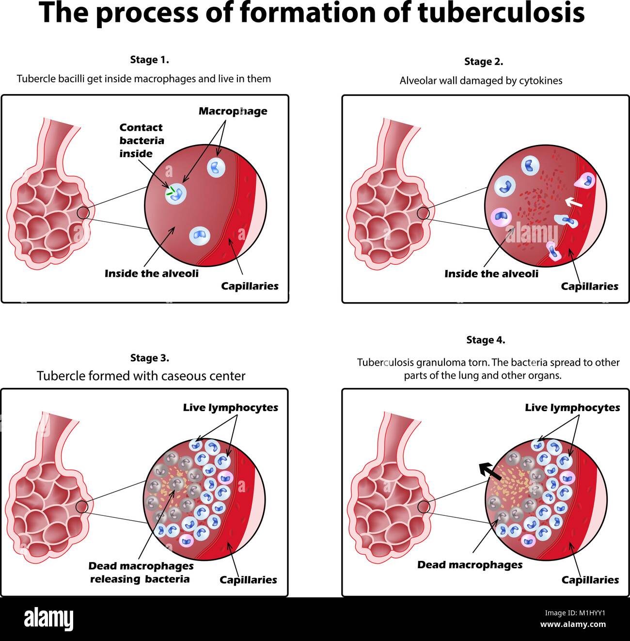 The process of tuberculosis formation. Infographics. Vector ...