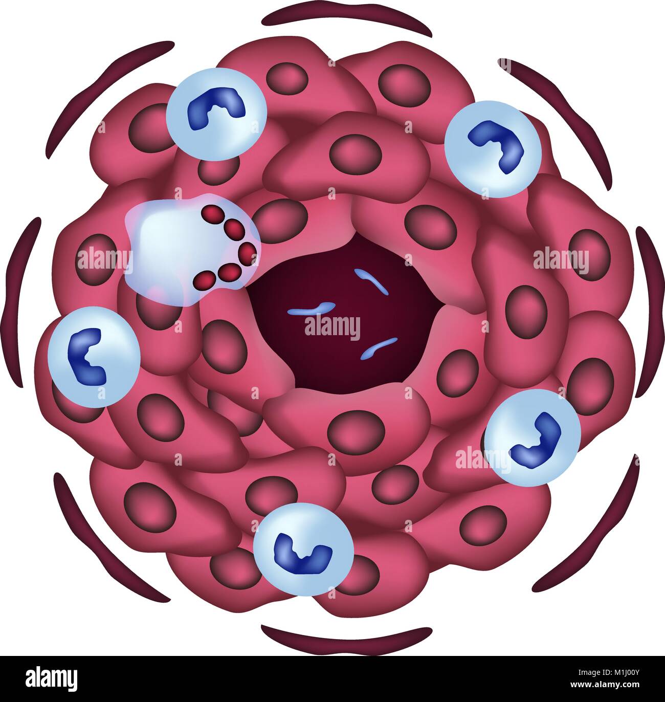 The structure of tuberculous granulomas. Infographics. Vector illustration on isolated ...