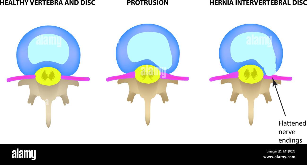 Disc Extrusion Stock Photos & Disc Extrusion Stock Images - Alamy