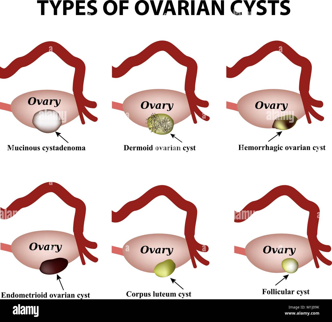 Types Of Ovarian Cysts Set Infographics Vector Illustration On Isolated Background Stock