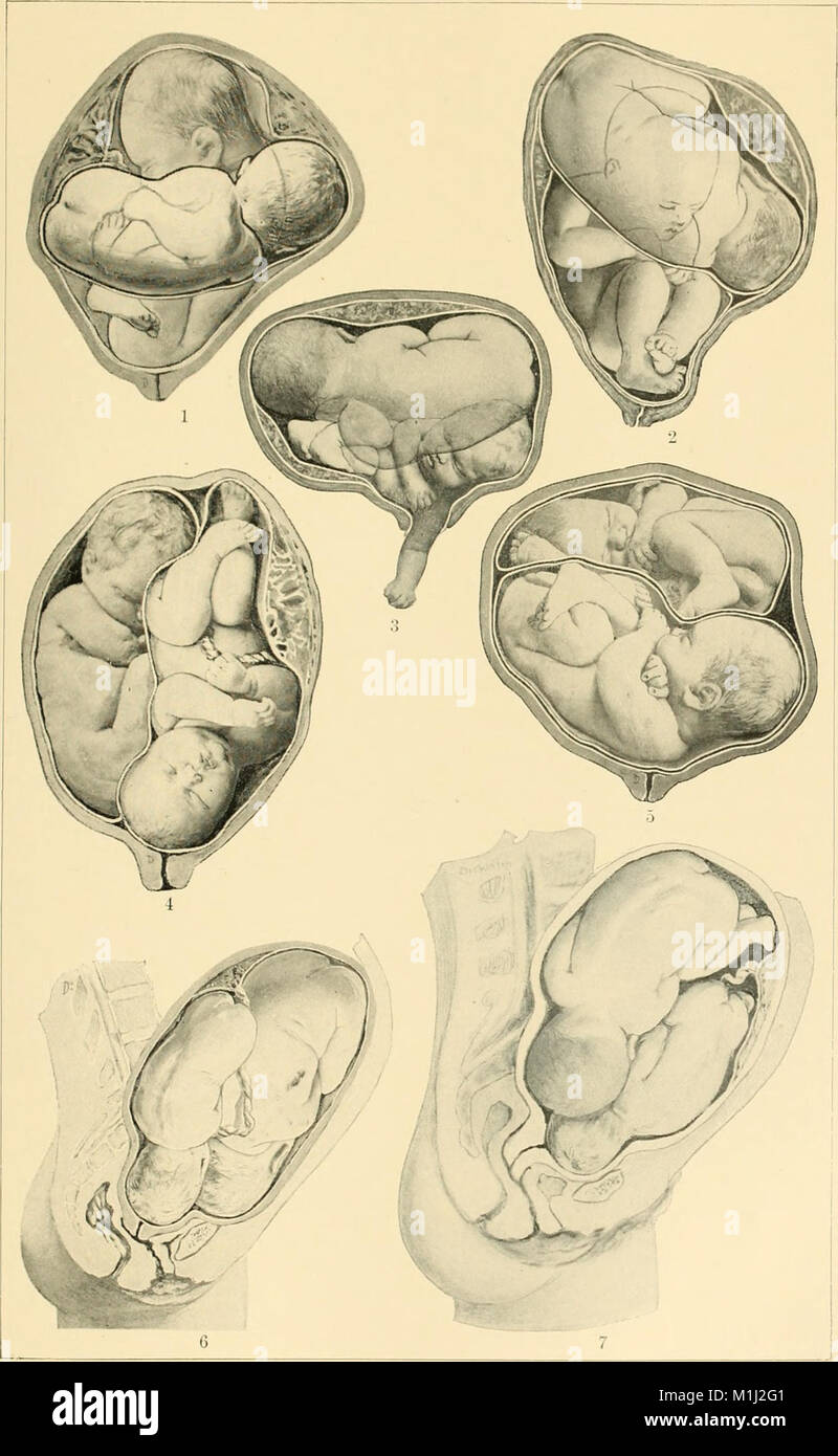 'An American Text-Book of Obstetrics' (1897) provides comprehensive ...