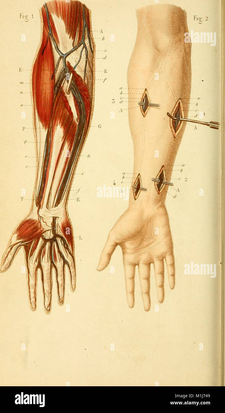 A text book of operative surgery and surgical anatomy (1878 ...